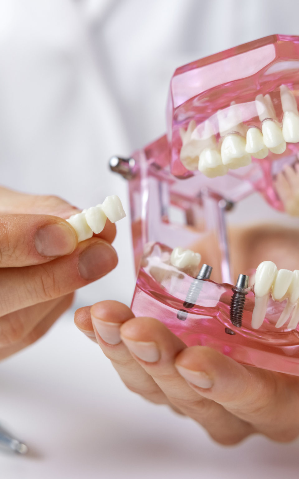 Dental Bridge – Turquoise Medical International